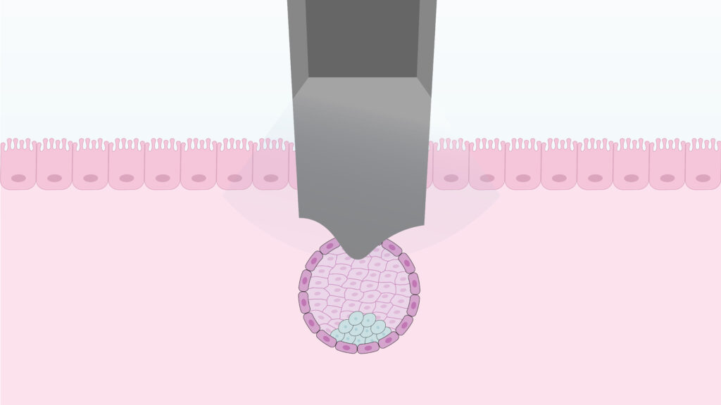 Engineering Implantation: Redefining Embryo Transfer